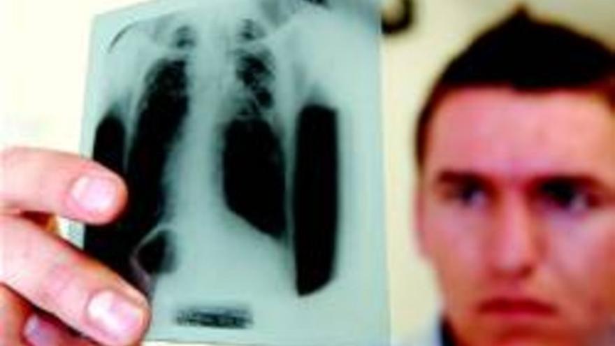 La OMS alerta del avance de la tuberculosis multirresistente