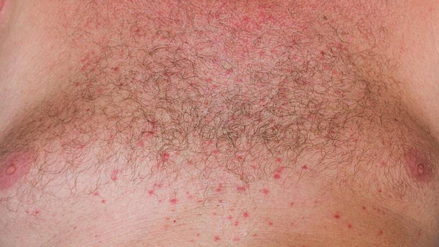 MILIARIA | Qué es y cómo se evita el sarpullido más típico del verano