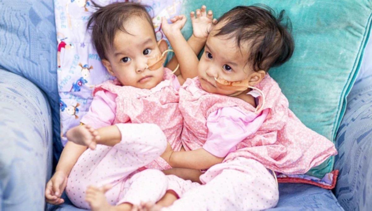 Las siamesas separadas en Australia aún quieren estar juntas