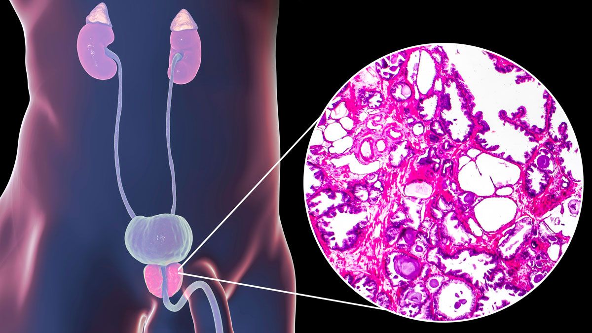 Cuándo y cómo se debe tratar la Hiperplasia Benigna de Próstata